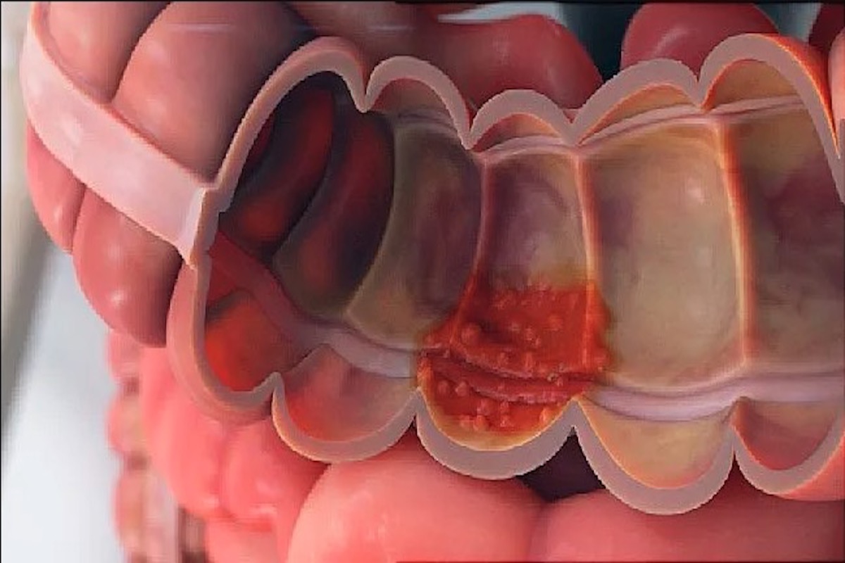 Ulcerative Colitis Causes Symptoms And Treatment Options
