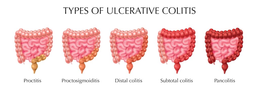 Ulcerative Colitis: Causes, Symptoms & Treatment Options