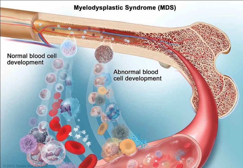 Myelodysplastic Syndromes: Types, Symptoms & Treatments