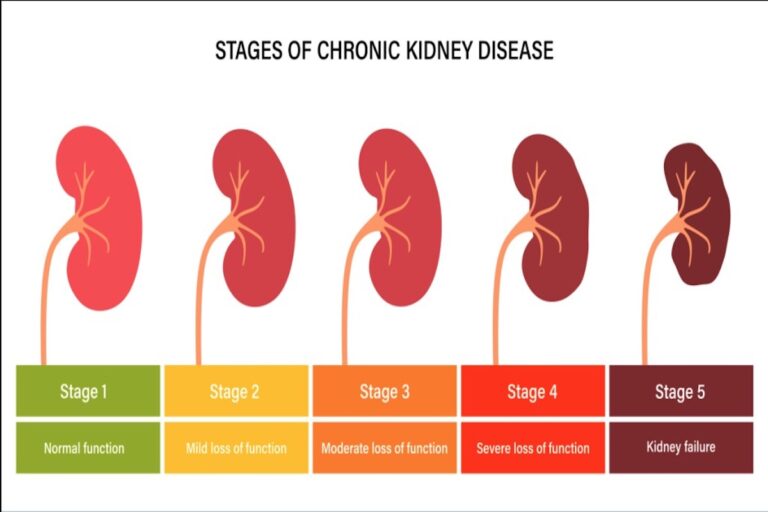 (Chronic) Kidney Disease: Causes, Stages, Symptoms & Treatment