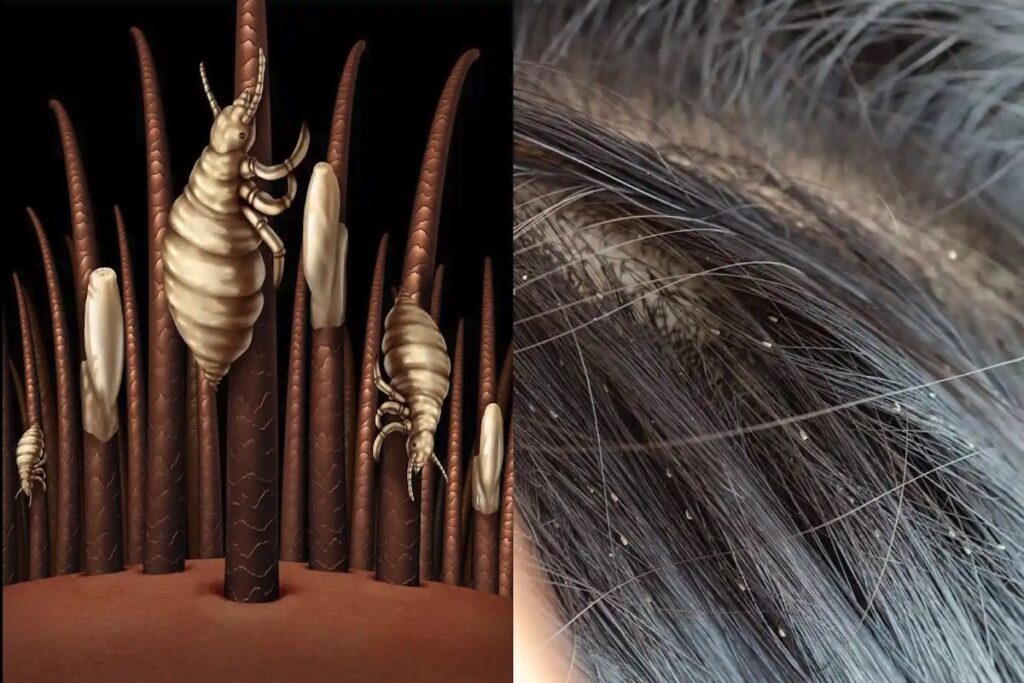 Head Lice: Causes, Symptoms and How to Get Rid of It