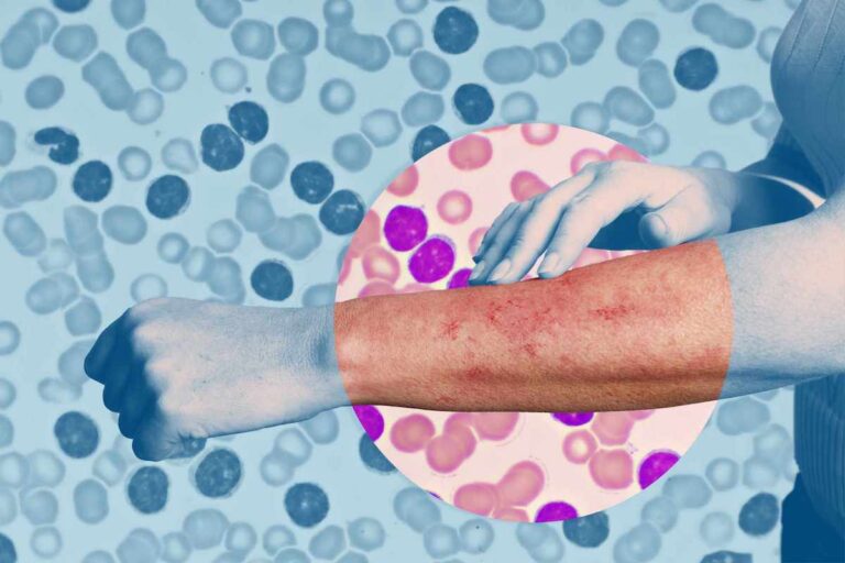 Leukemia: Learn about Types, Symptoms & Treatment Options