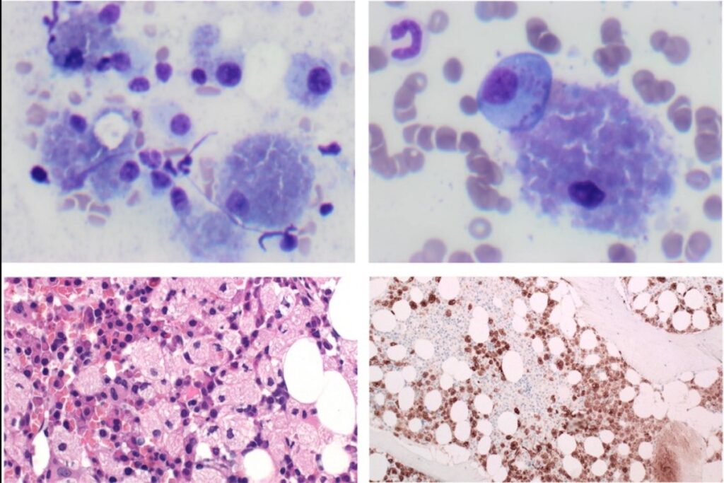 9 Types of Plasma Cell Disorders