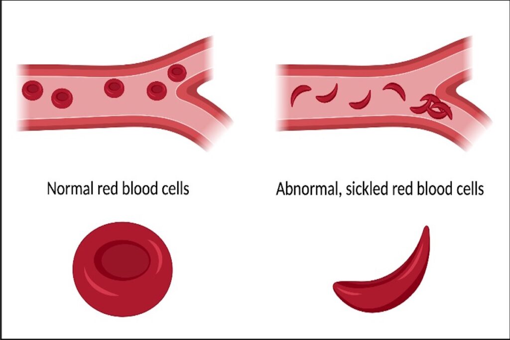 Sickle Cell Anemia Causes Symptoms And Treatment Options