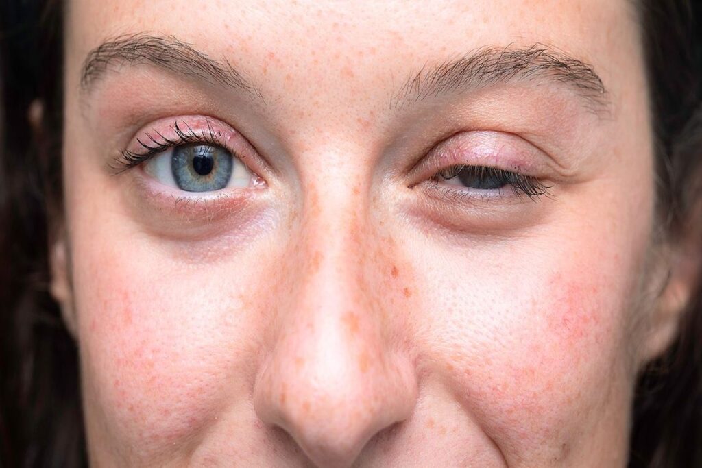 Myasthenia Gravis: Causes, Symptoms & Treatment Options