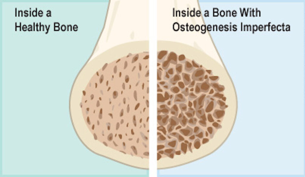 Osteogenesis Imperfecta: Causes, Symptoms & Treatments