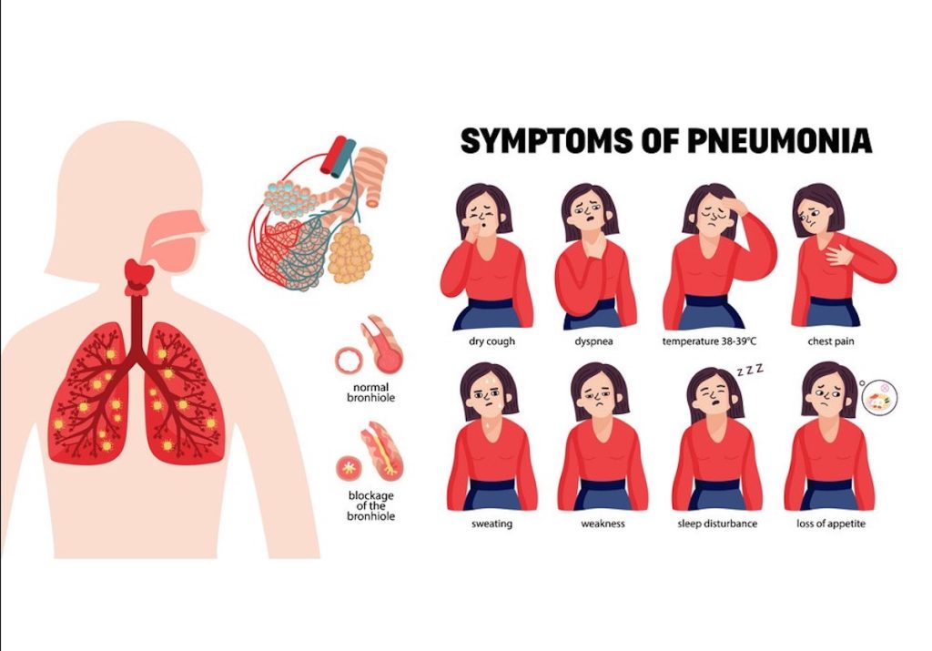 Pneumonia: Causes, Symptoms & Treatment Options